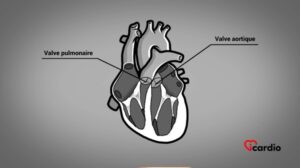 Sténose aortique – Icardio