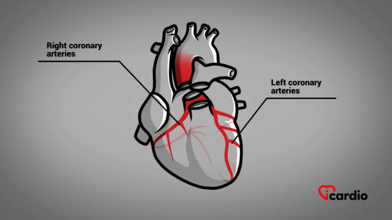 Myocardial infarction – STEMI – Icardio