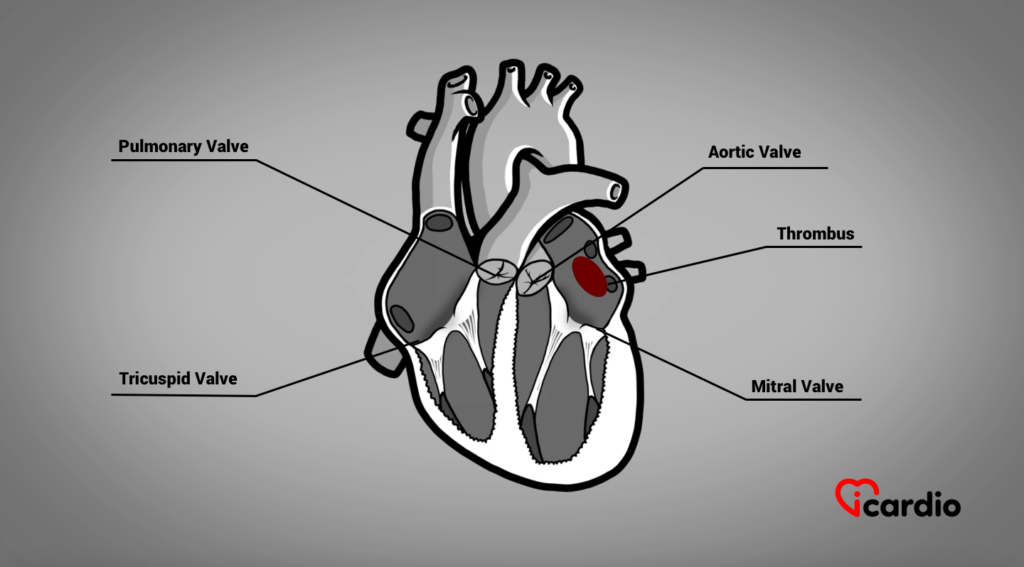 Atrial fibrillation (AF) – medical point of view – Icardio