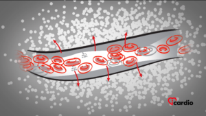 Water “in” the lungs, also known as Pulmonary Edema – Icardio