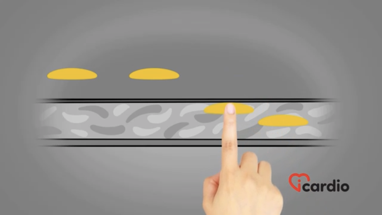 Plaque d’athérome (Athérosclérose) – Icardio