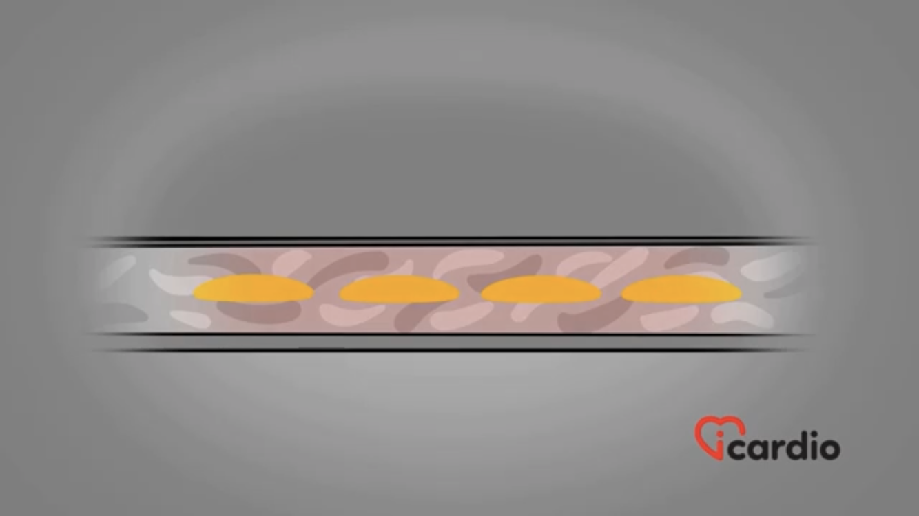 Plaque d’athérome (Athérosclérose) – Icardio