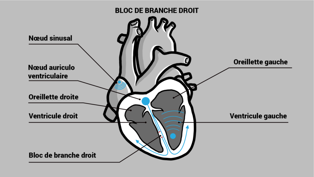 Bloc de Branche – Icardio