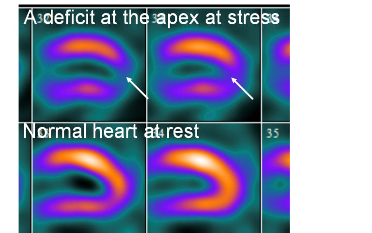 The myocardial scintigraphy with persantine – Icardio