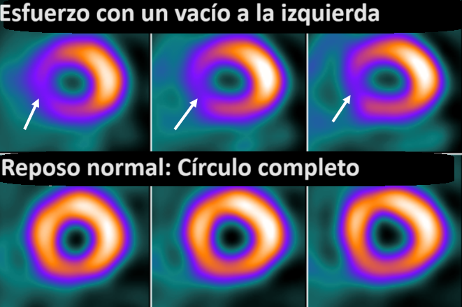 Gammagrafía miocárdica o MIBI con esfuerzo – Icardio