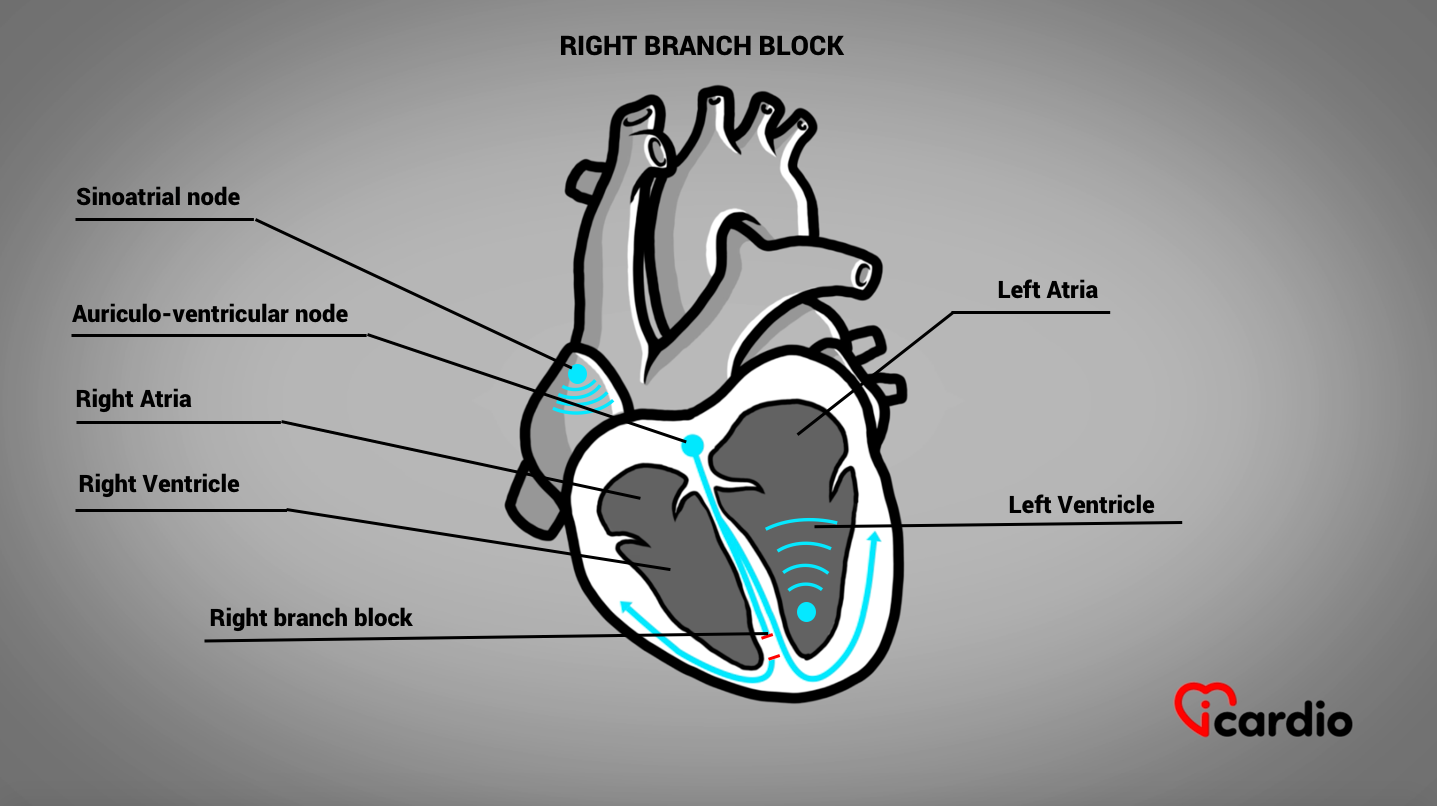 Bundle Branch Block – Icardio