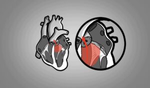 Sténose aortique – Icardio