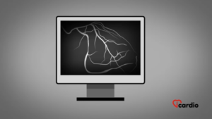 L’angioplastie coronarienne (PCI) – Icardio