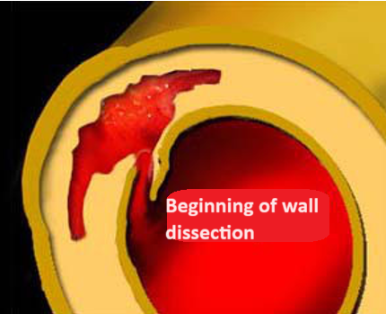 Spontaneous Coronary Artery Dissection (SCAD) – Icardio