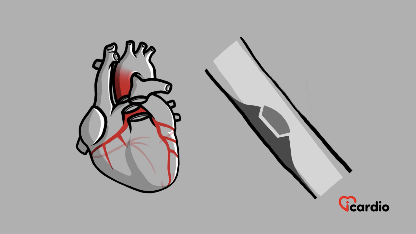 Myocardial infarction – STEMI – Icardio