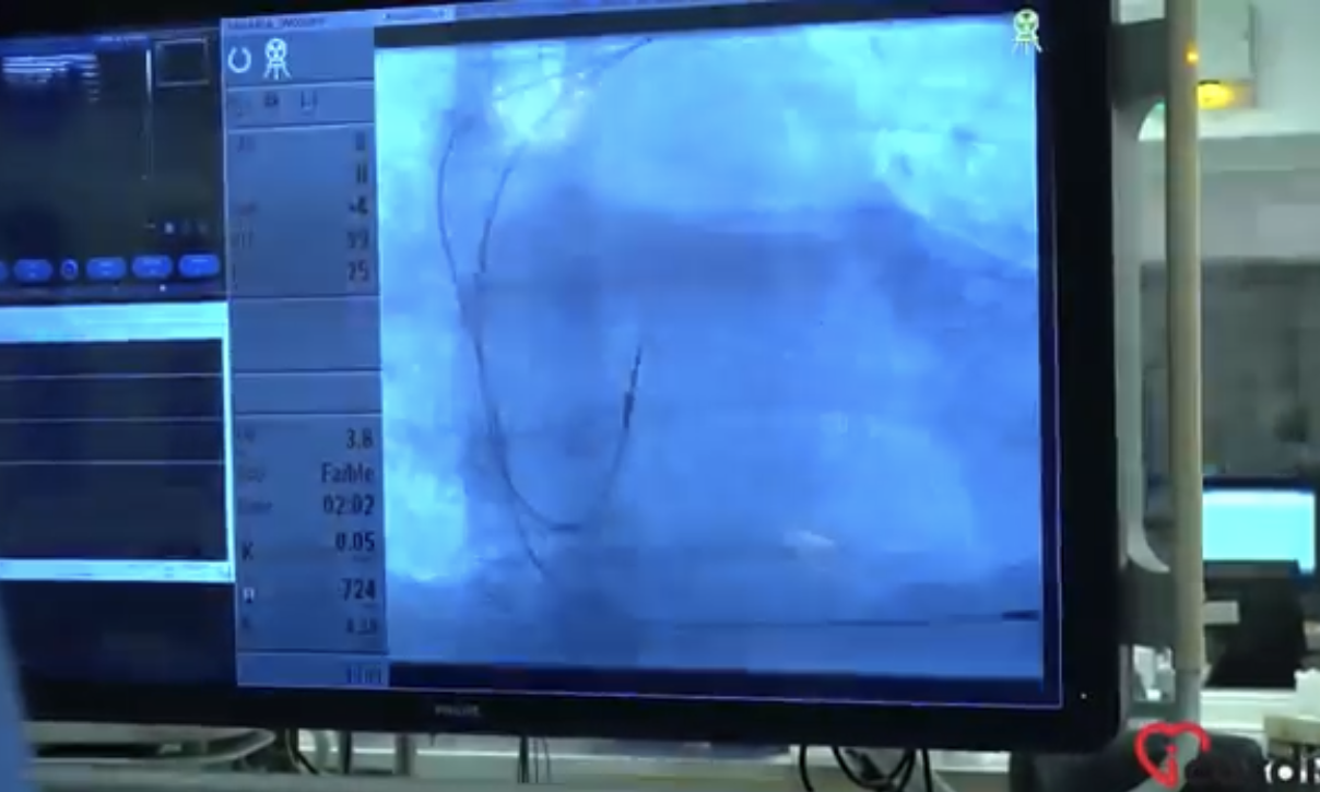 Installation d’un pacemaker – Icardio