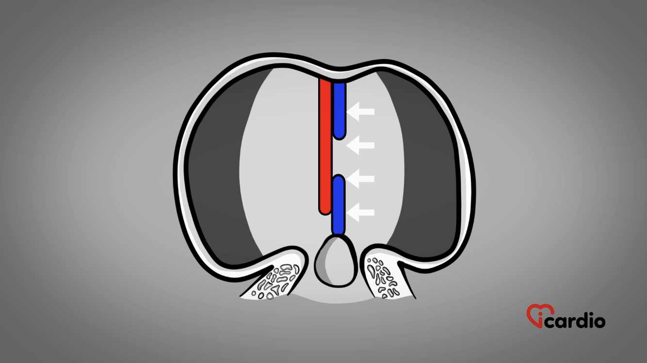 FOP – Foramen oval permeable – Icardio