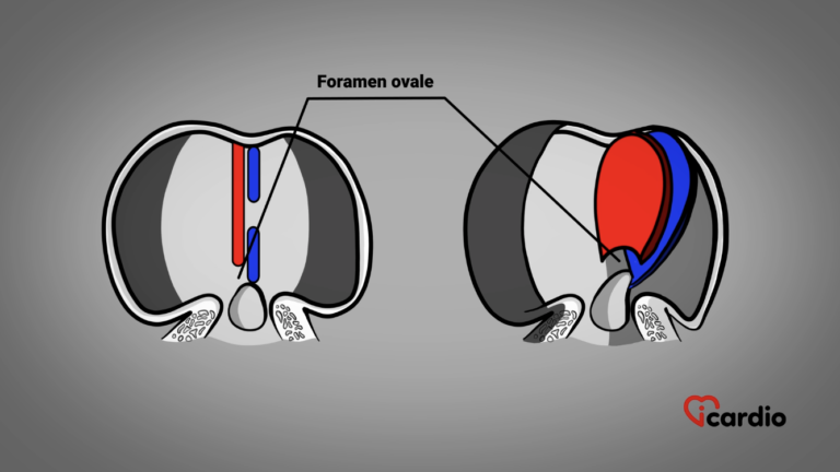 PFO – Patent Foramen Ovale – Icardio