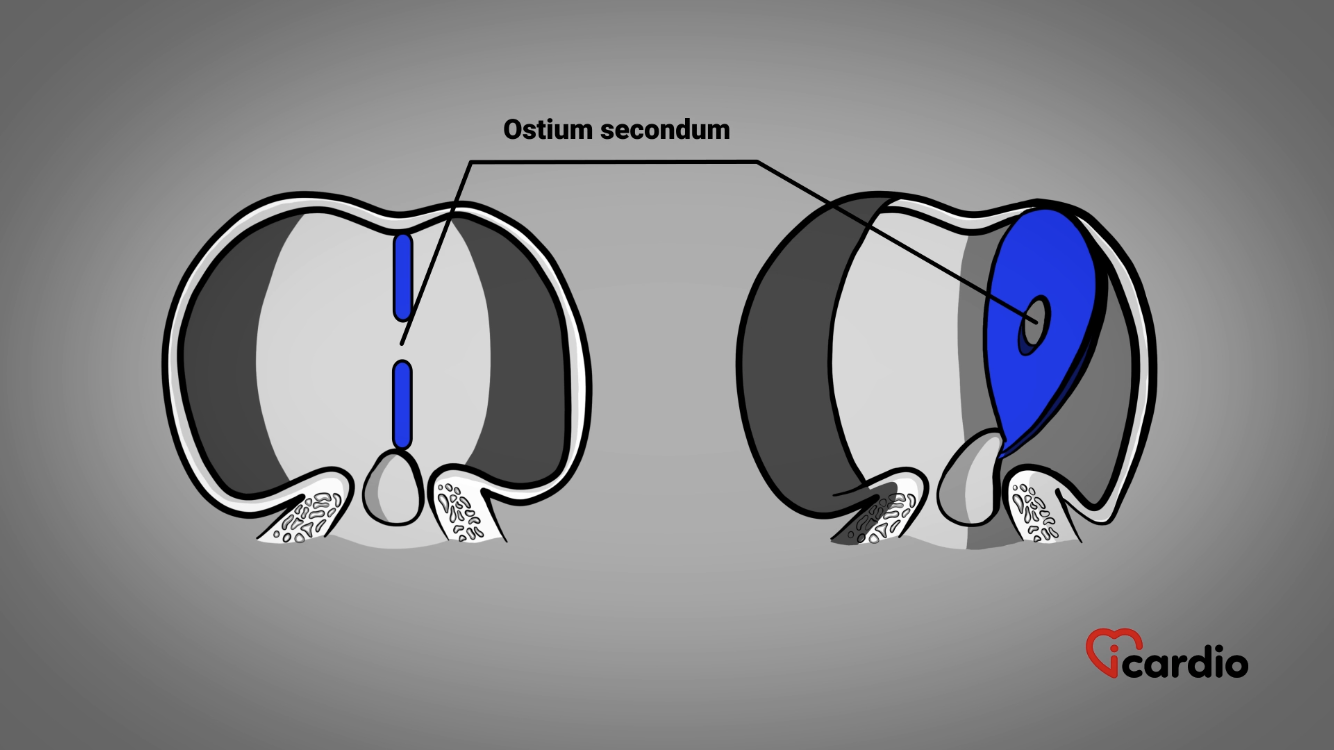 FOP – Foramen oval permeable – Icardio
