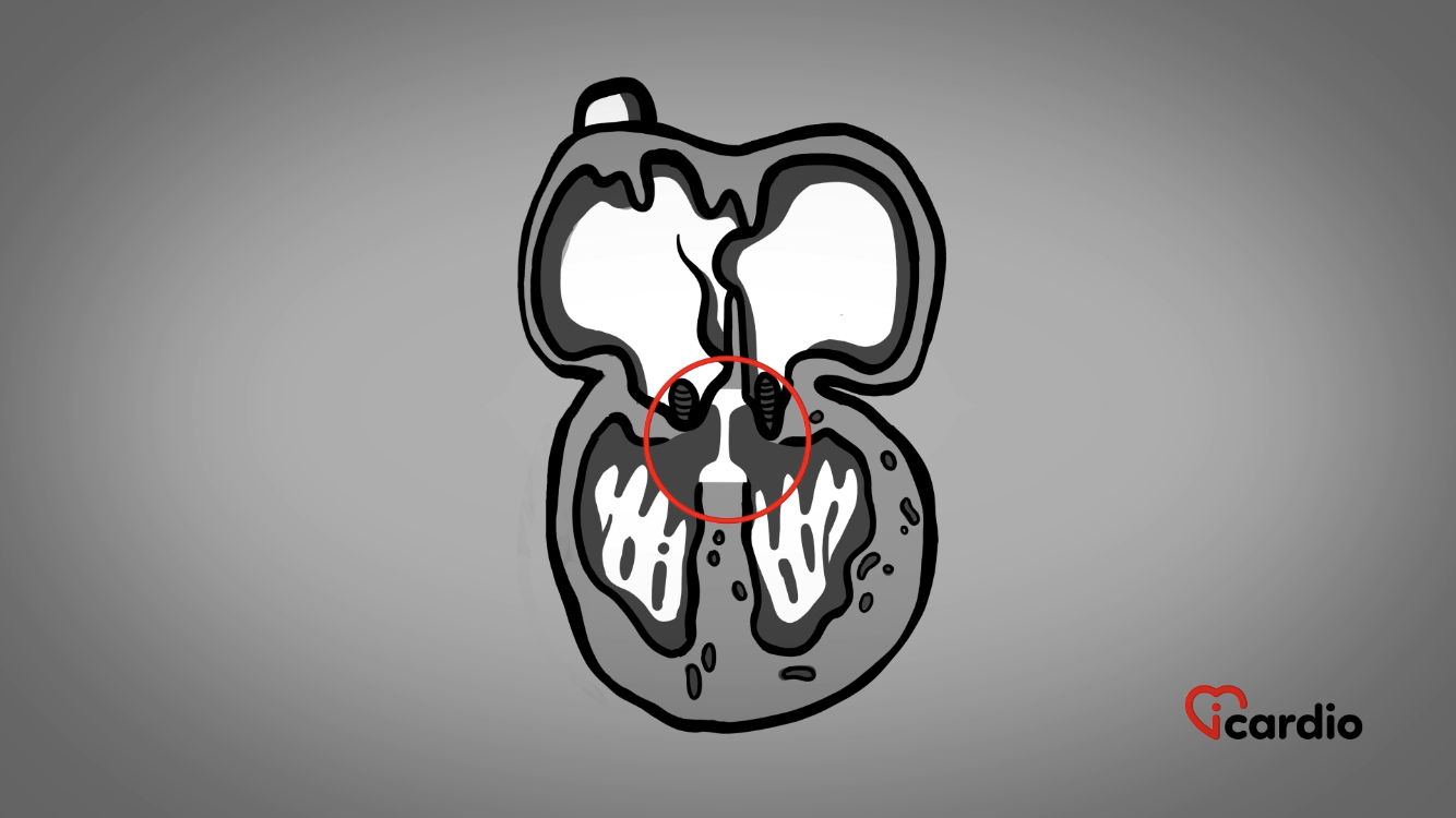 Comunicación interventricular (CIV) – Icardio