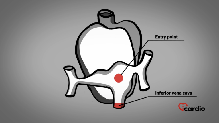 The Formation of the Atria and Venous Return – Icardio
