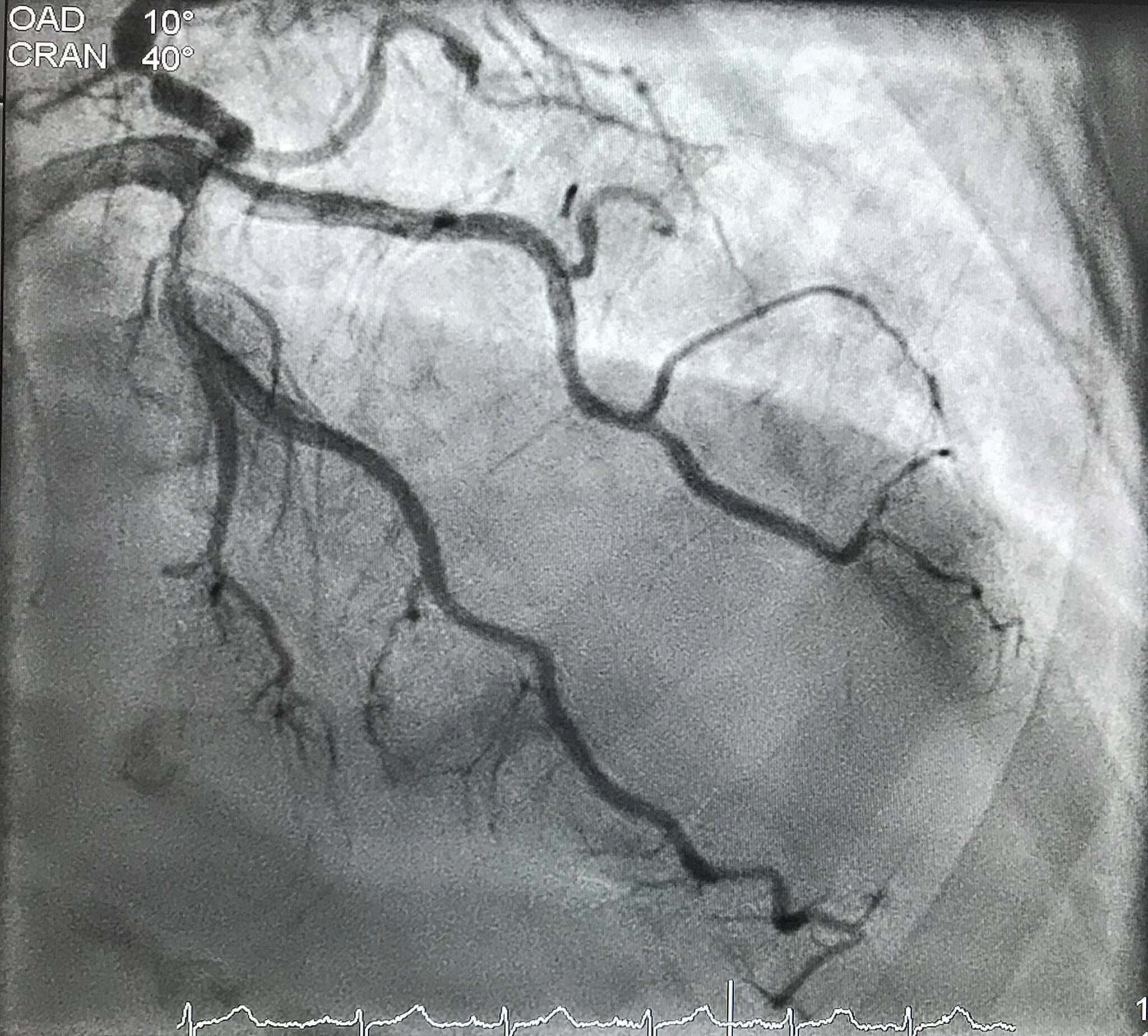 Myocardial infarction – STEMI – Icardio