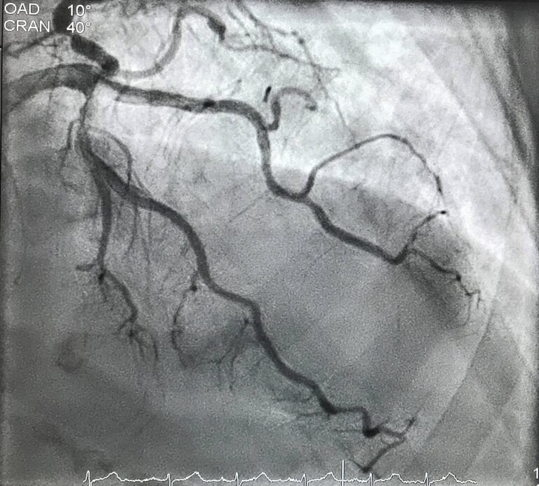 Infarto de miocardio – STEMI – Icardio