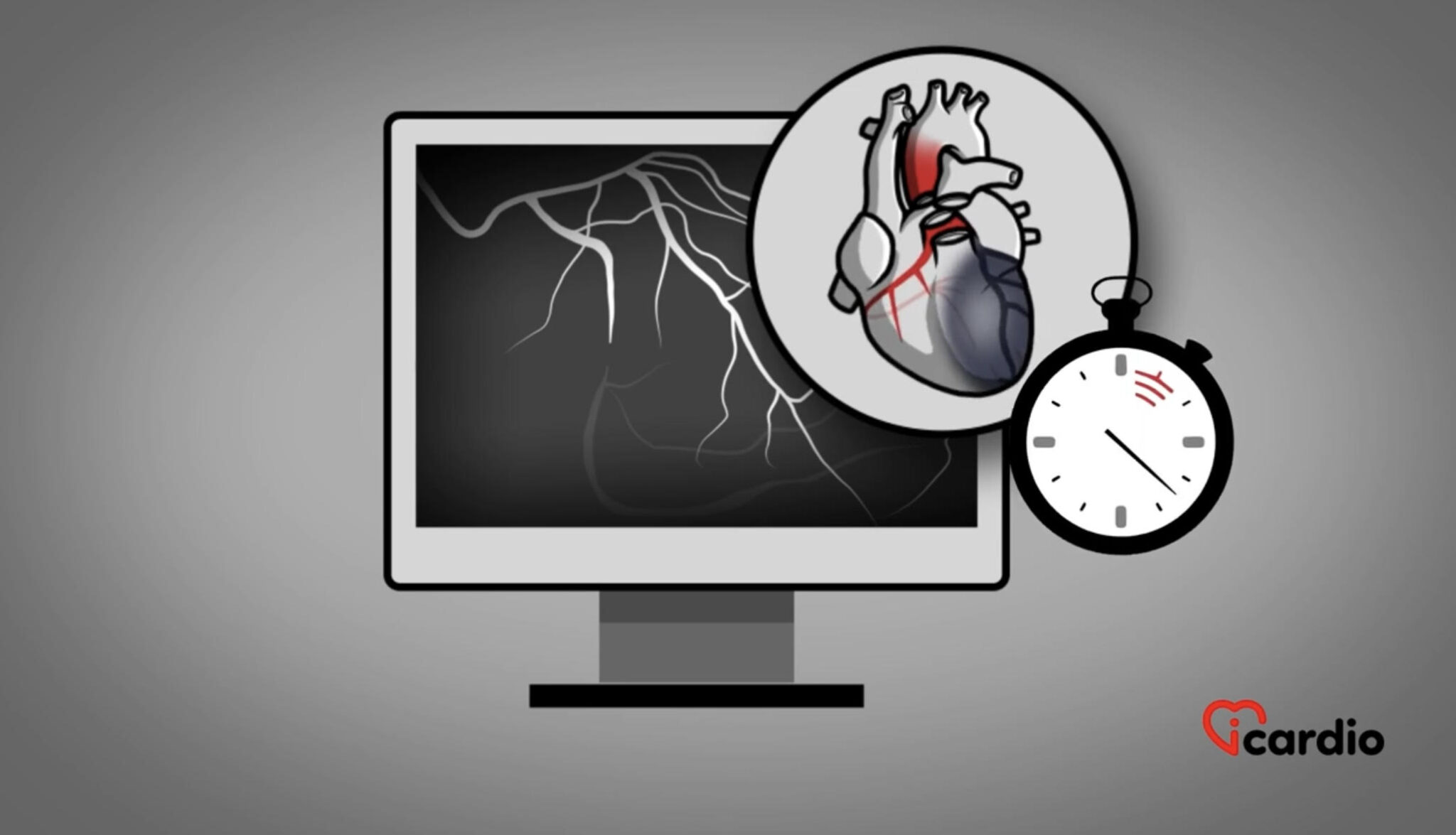Myocardial infarction – STEMI – Icardio